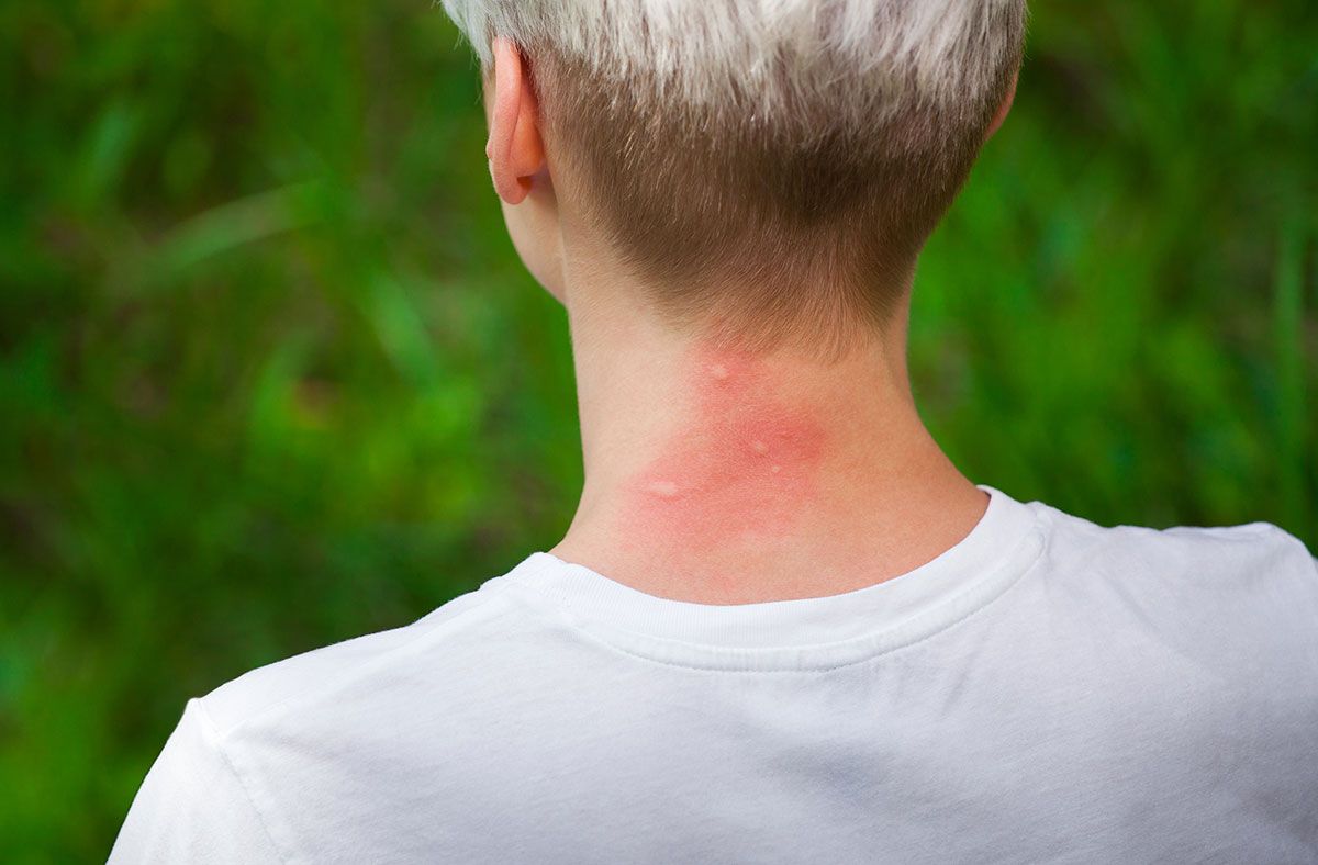 Allergic Disease & Asthma Center | Insect Sting Allergies